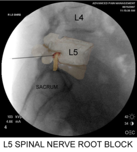 Epidural Steroid Injections and Selective Nerve Root Blocks