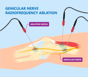 Genicular Nerve Block for Chronic Knee Pain - Barr Center