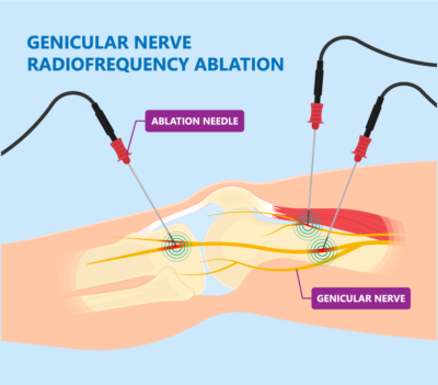 Genicular Nerve Block for Chronic Knee Pain - Barr Center