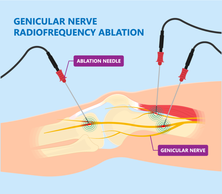 Genicular Nerve Block for Chronic Knee Pain - Barr Center Genicular Nerve Block for Chronic Knee Pain - Barr Center